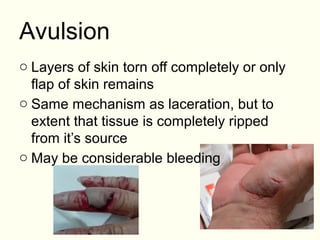 Mild Skin Avulsion