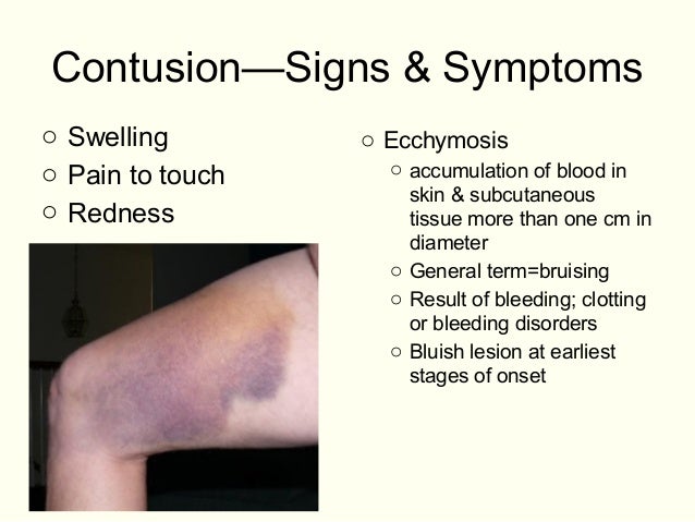 Ecchymosis Vs Bruise