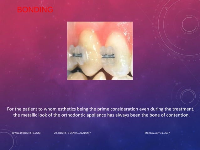 BANDING AND BONDING INN ORTHODONTICS | PPT | Oral care | Personal Care