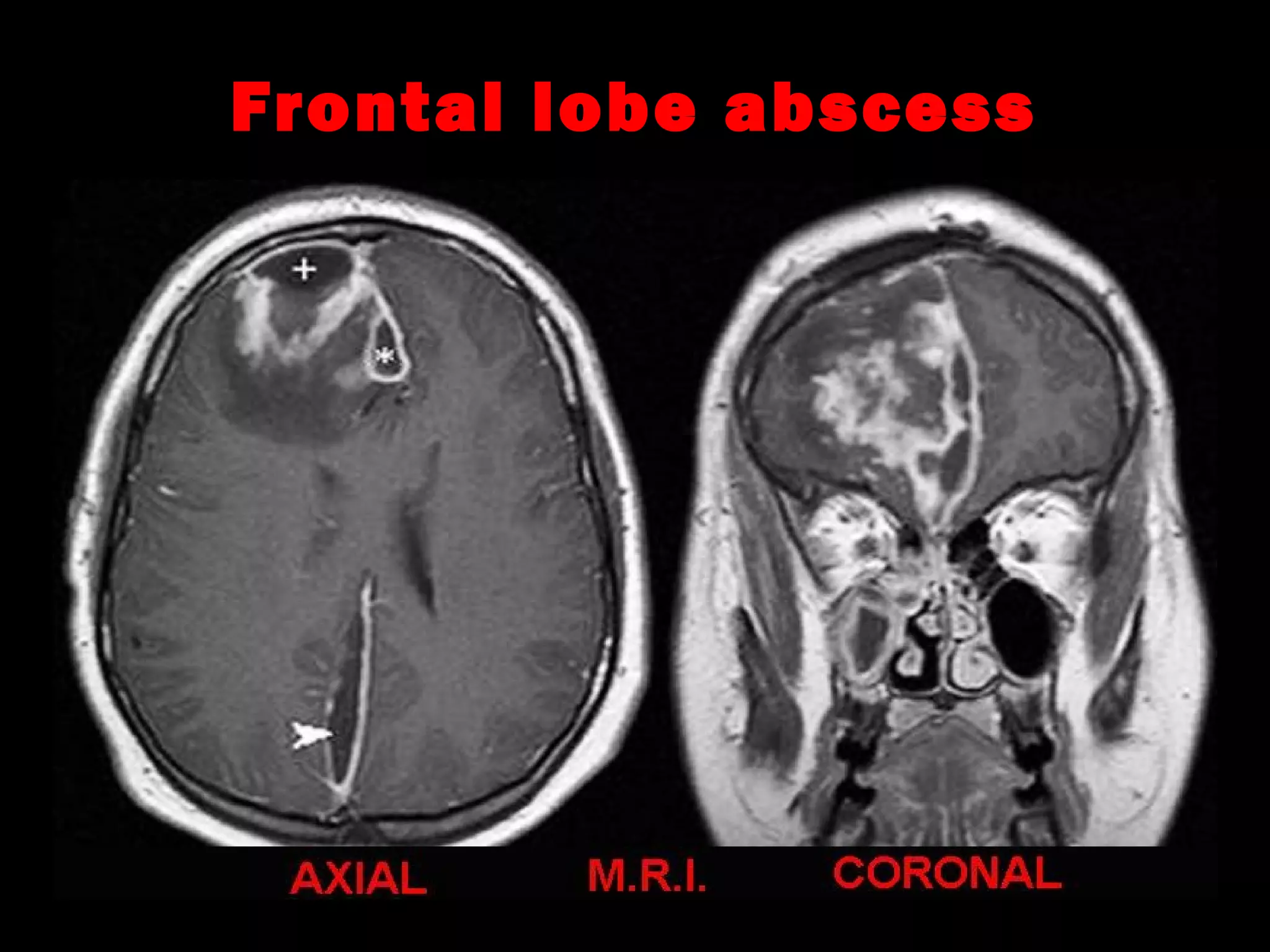 Complications of sinusitis | PPT