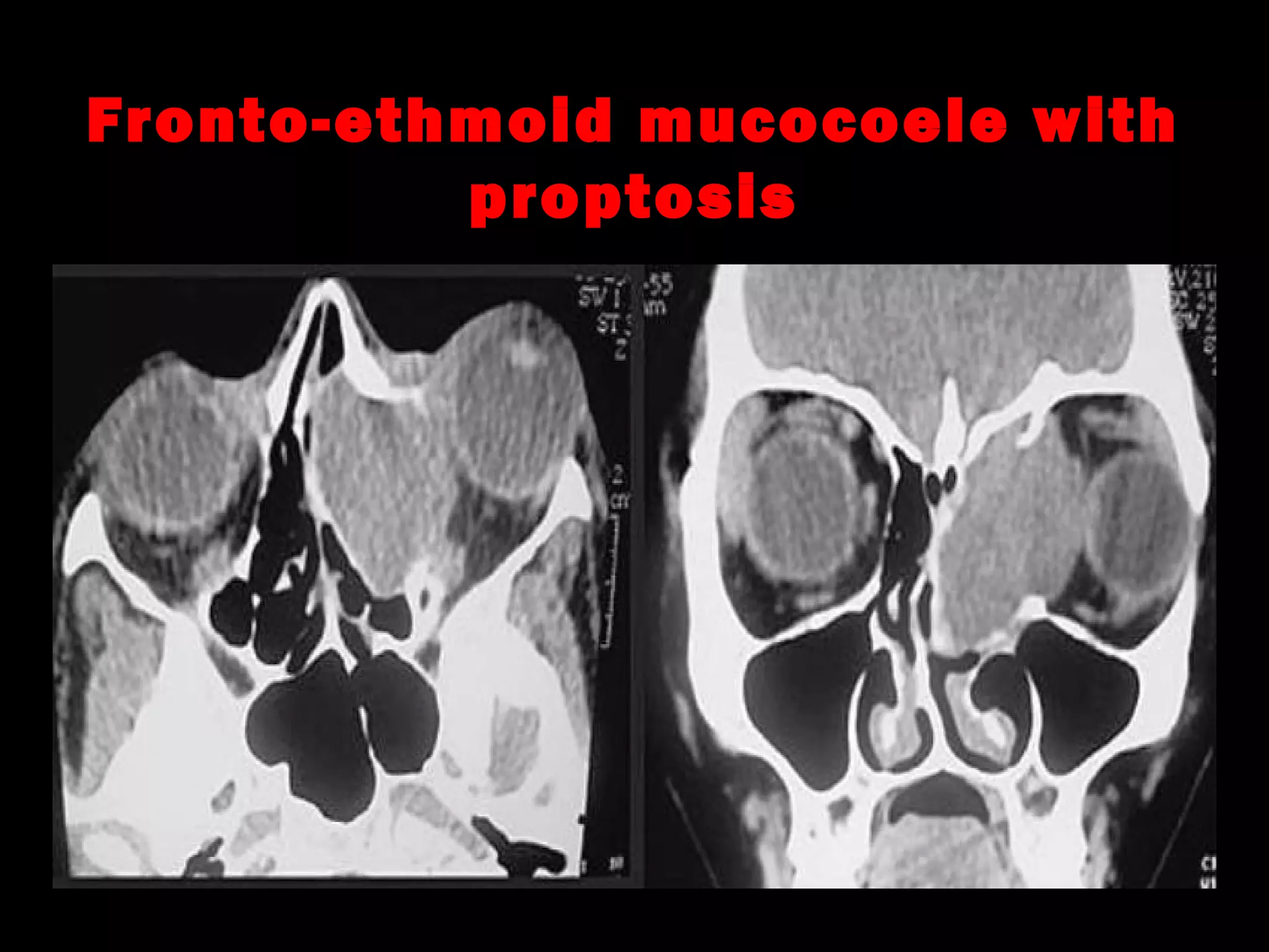 Complications of sinusitis | PPT