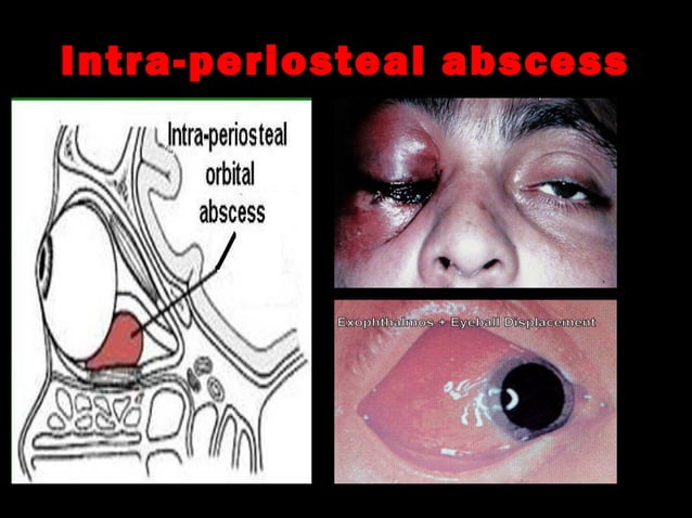 Complications of sinusitis | PPT