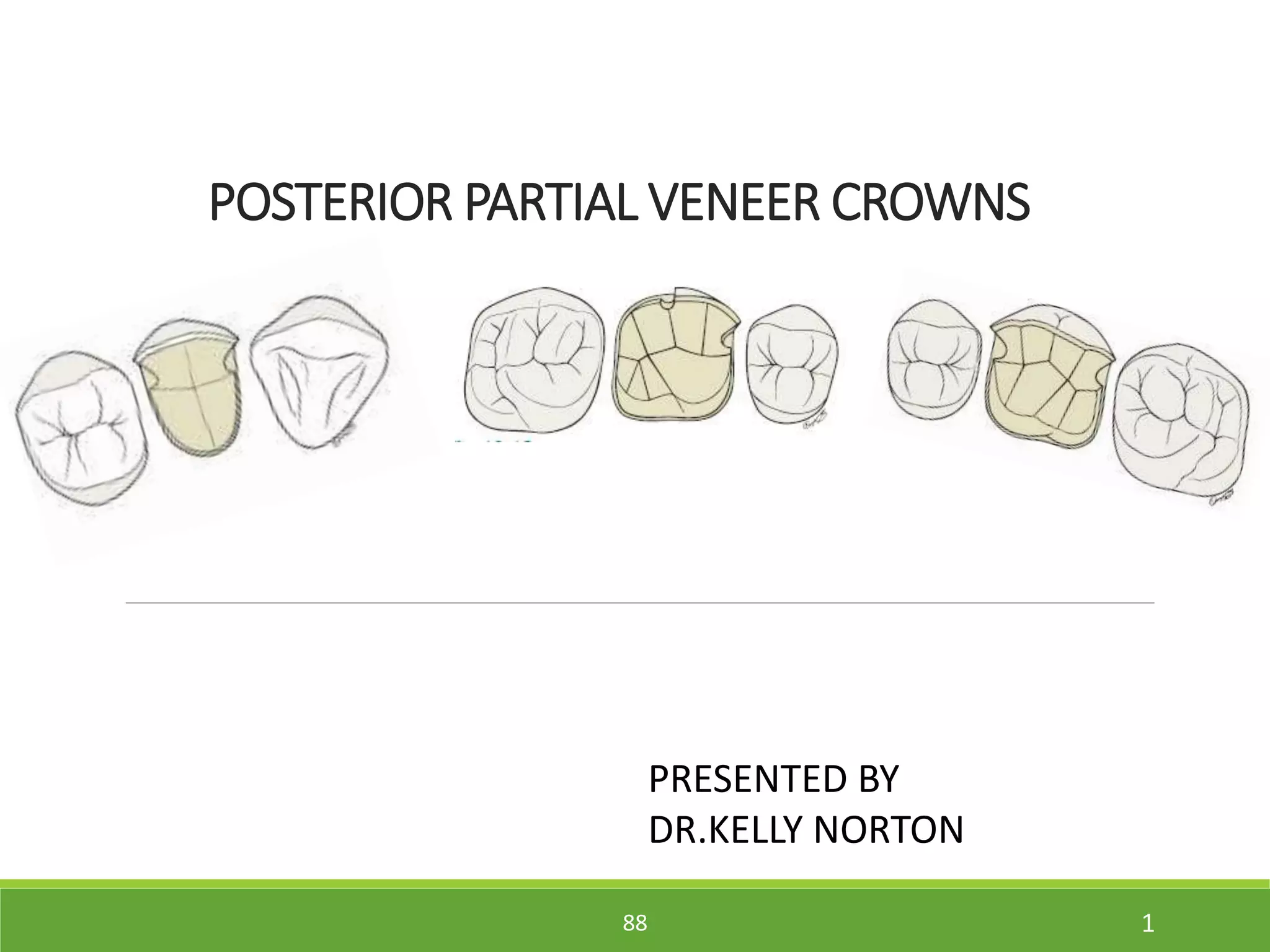 posterior partial veneer crowns - Kelly | PPTX