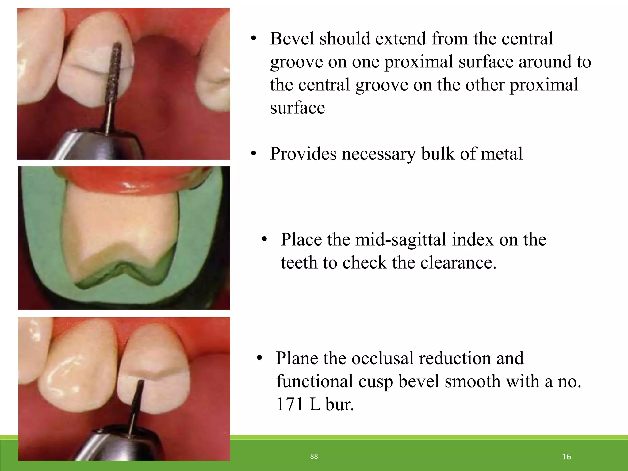 posterior partial veneer crowns - Kelly | PPTX | Dental Health ...
