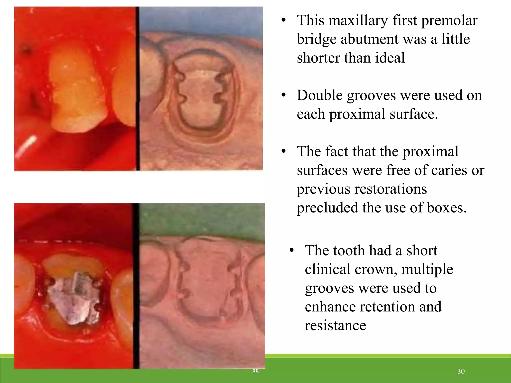 posterior partial veneer crowns - Kelly | PPTX | Dental Health ...