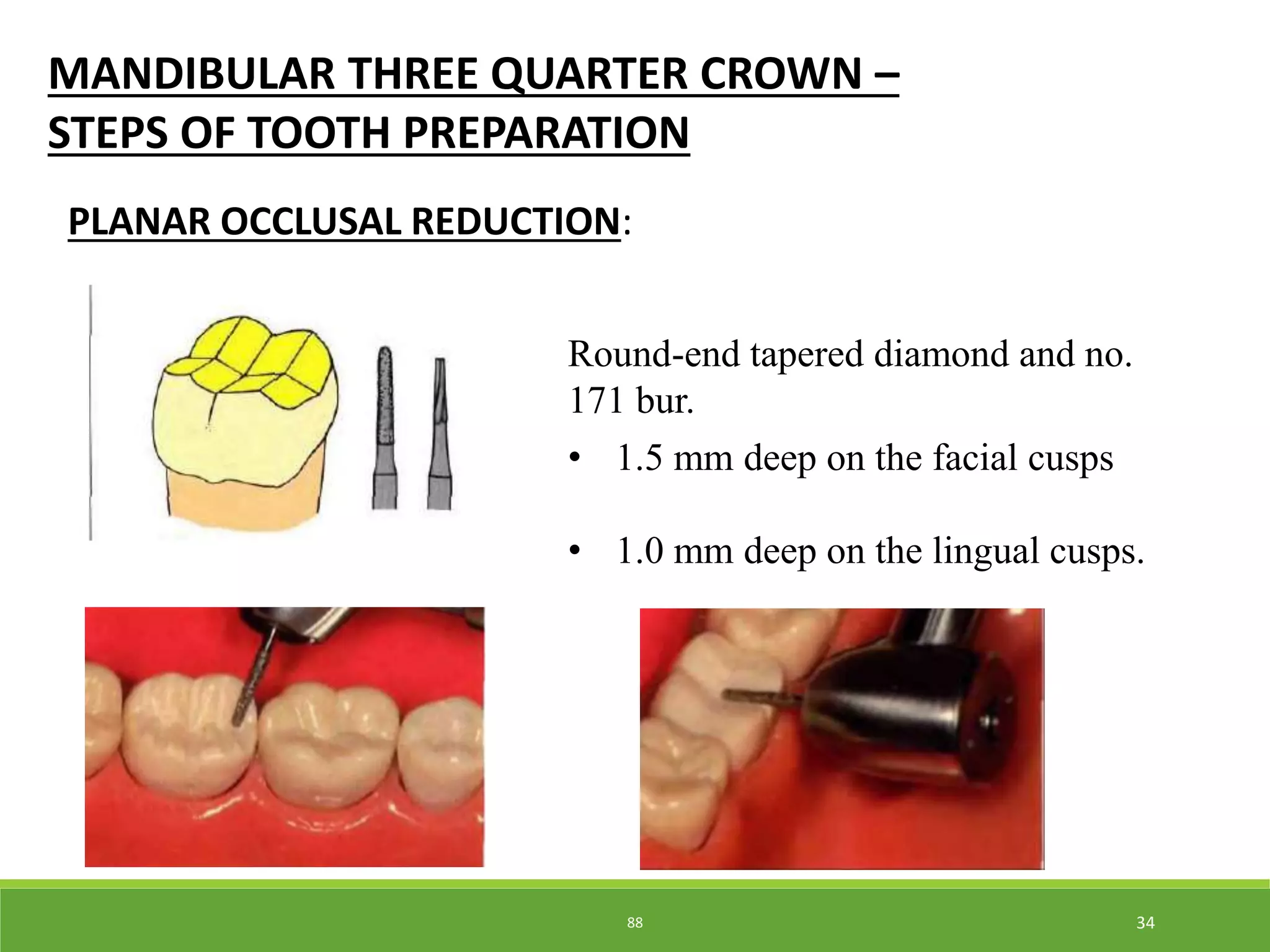 posterior partial veneer crowns - Kelly | PPTX