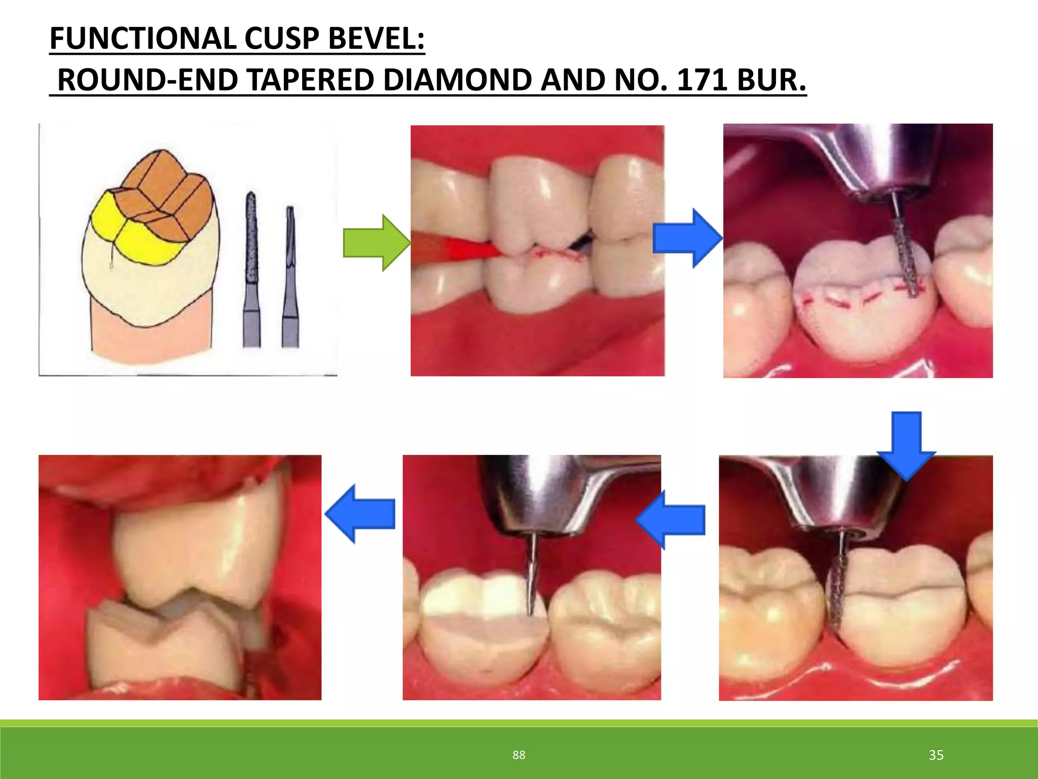 posterior partial veneer crowns - Kelly | PPTX