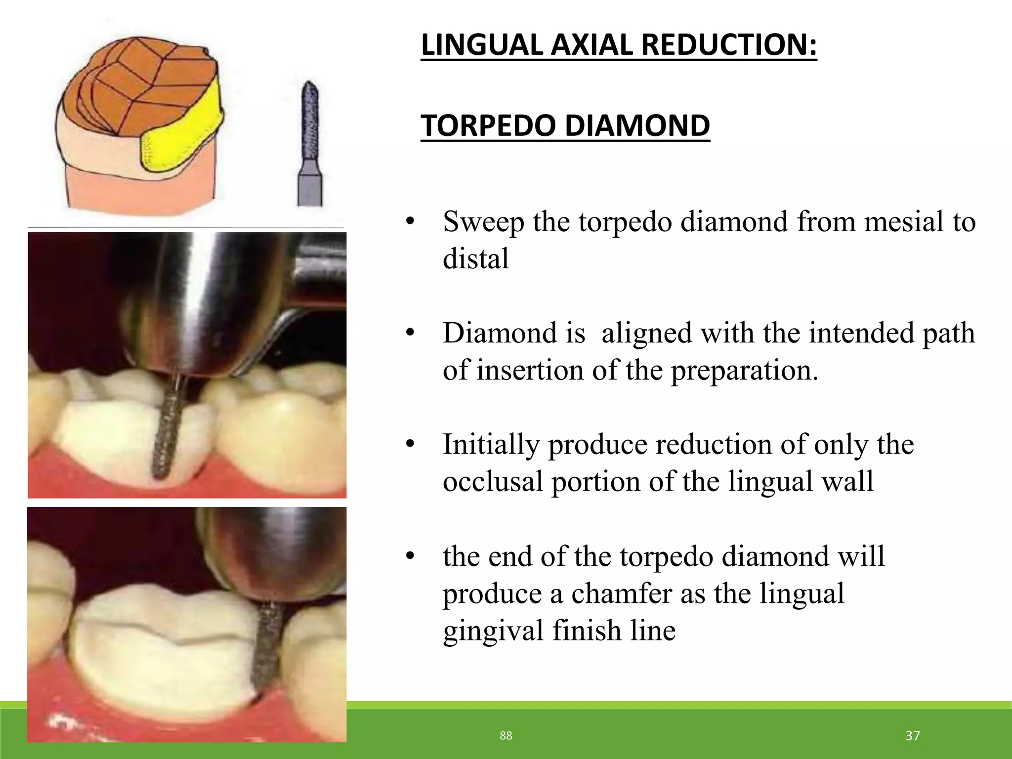 posterior partial veneer crowns - Kelly | PPTX
