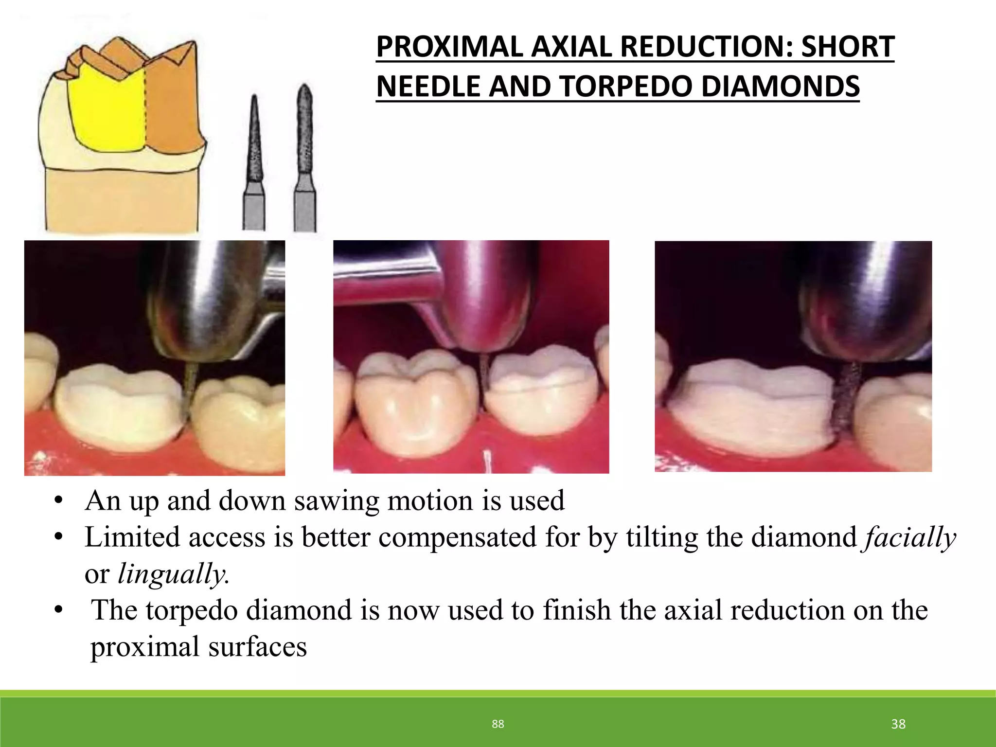 posterior partial veneer crowns - Kelly | PPTX | Dental Health ...