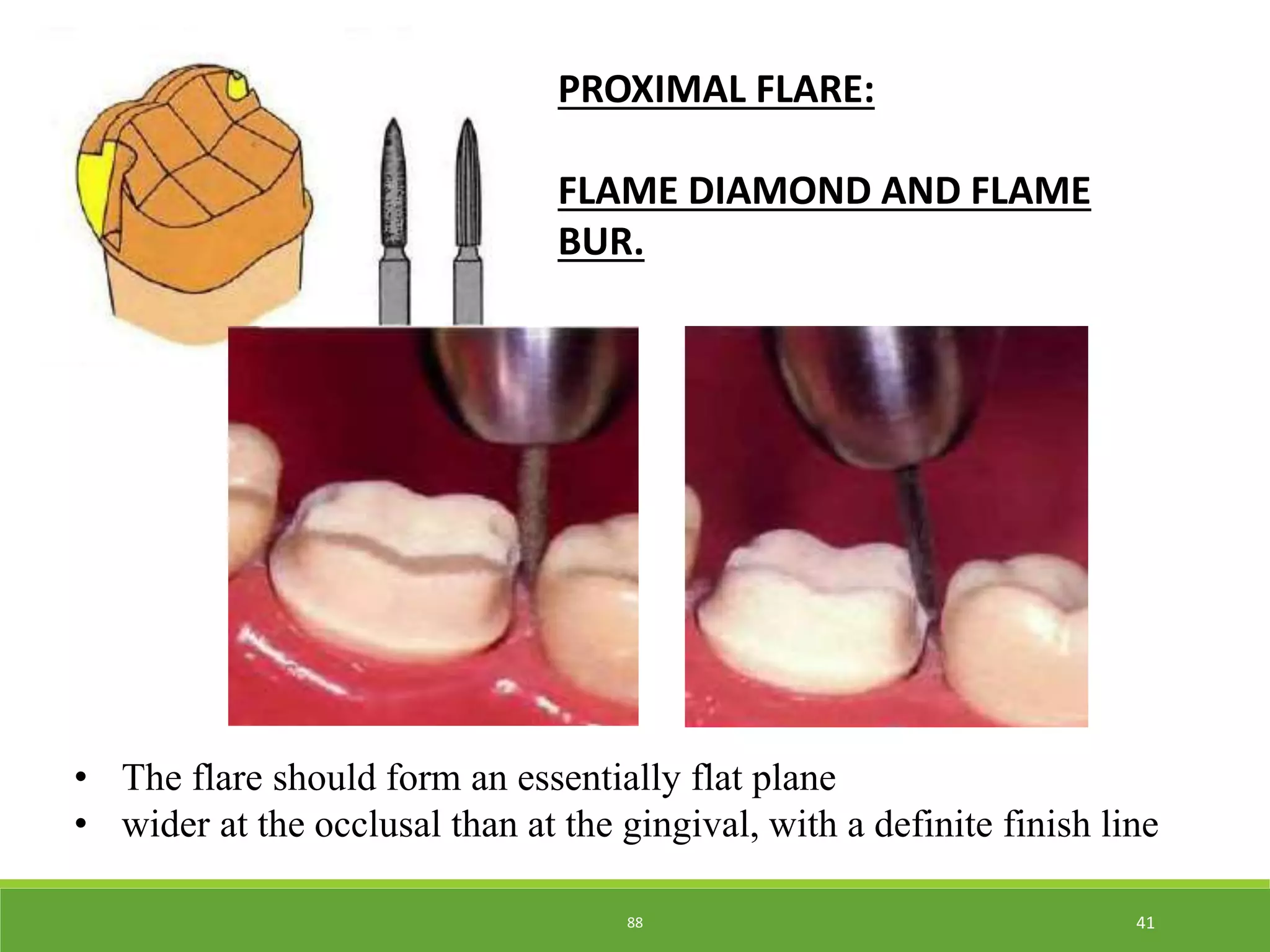 posterior partial veneer crowns - Kelly | PPTX