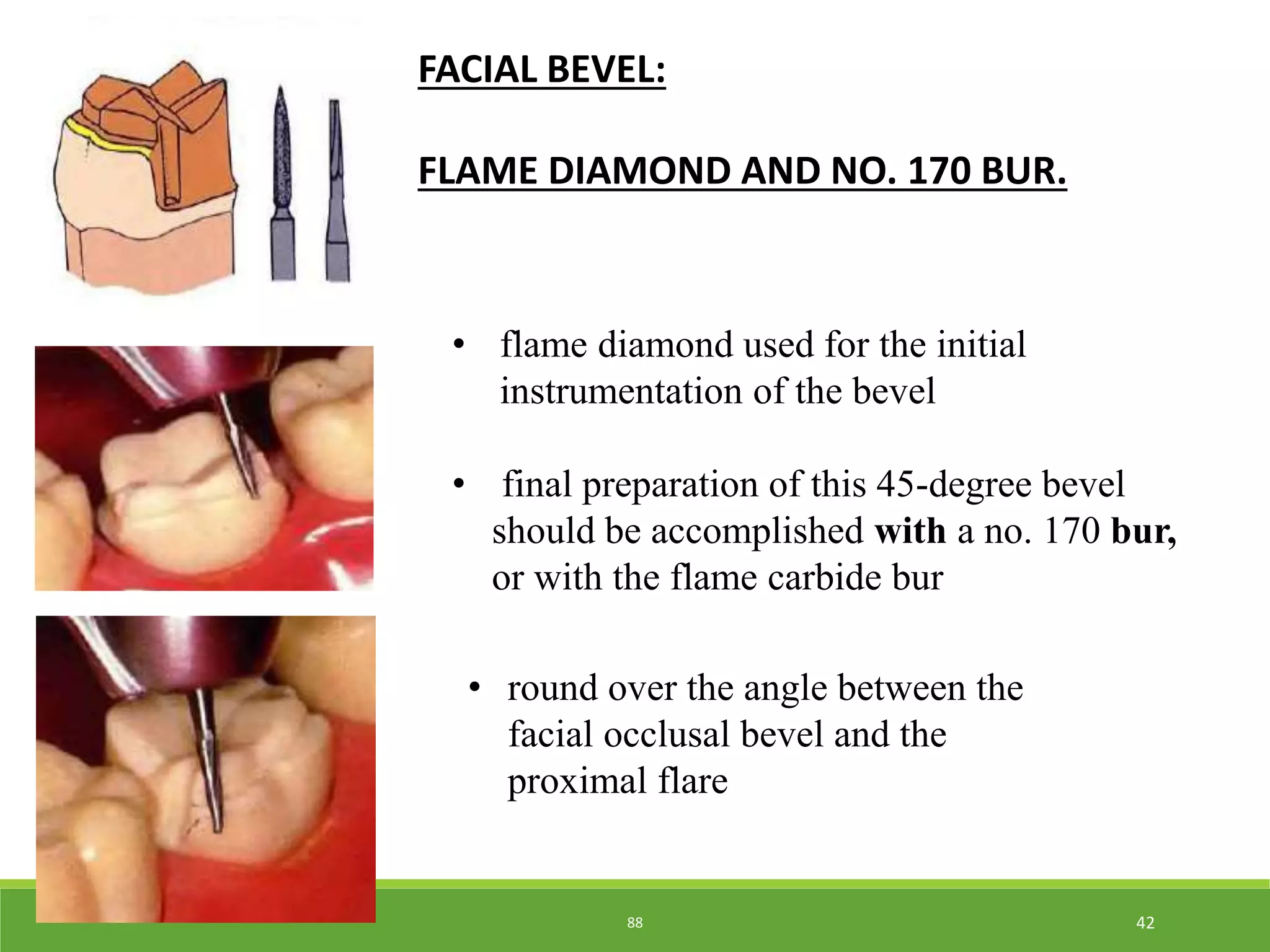 posterior partial veneer crowns - Kelly | PPTX | Dental Health ...