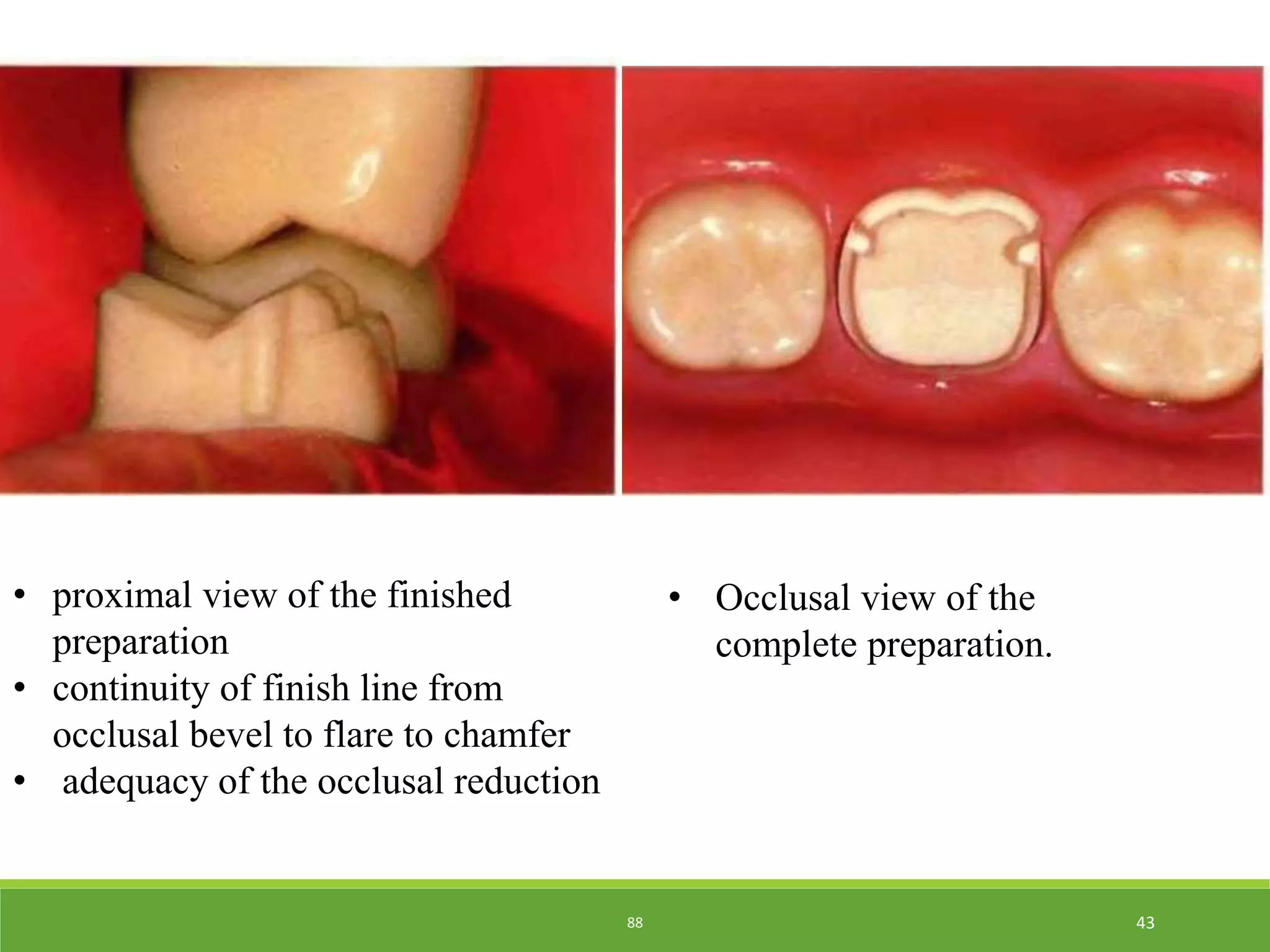 posterior partial veneer crowns - Kelly | PPTX