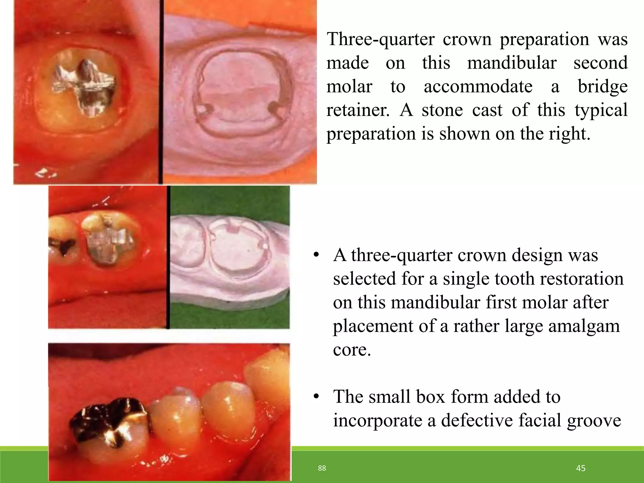 posterior partial veneer crowns - Kelly | PPTX