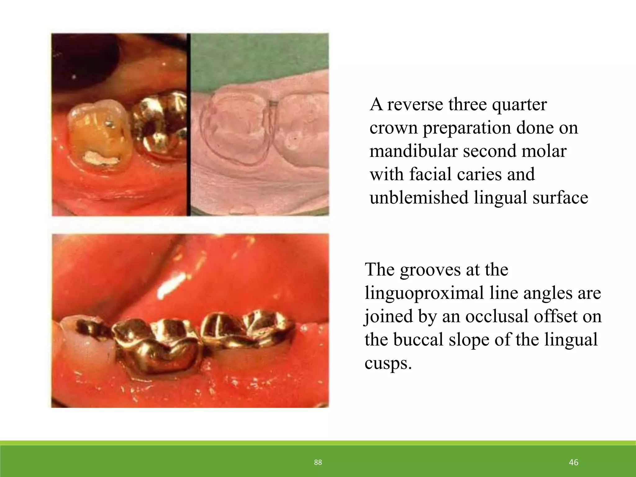 posterior partial veneer crowns - Kelly | PPTX