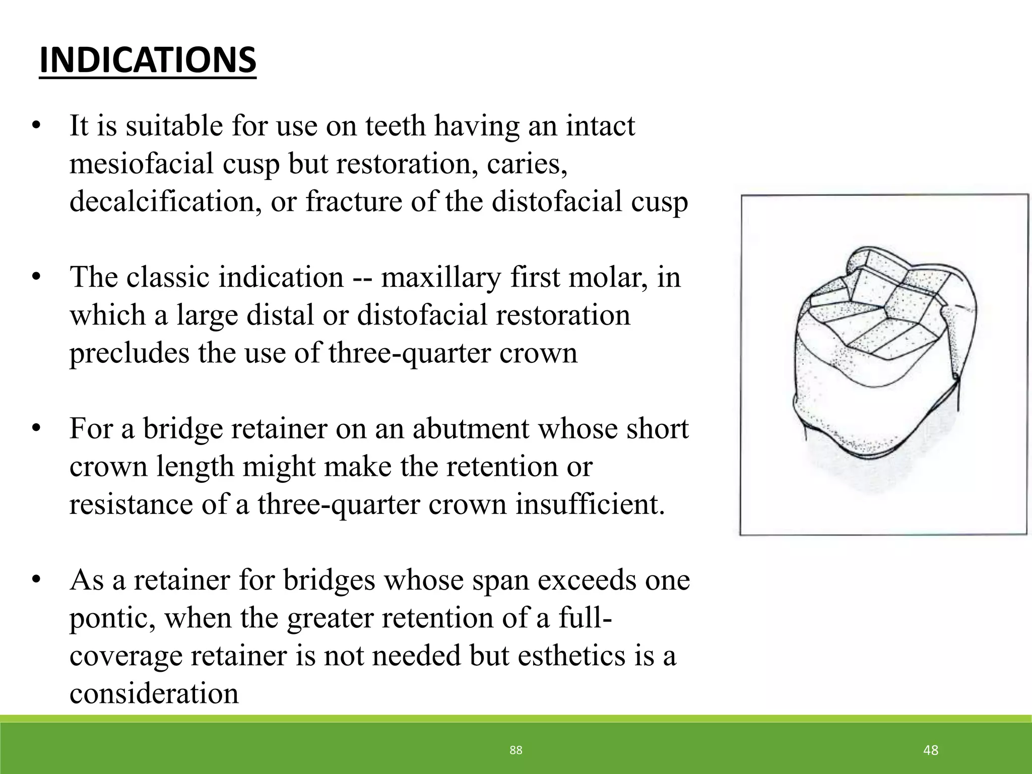 posterior partial veneer crowns - Kelly | PPTX