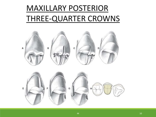 posterior partial veneer crowns - Kelly | PPTX | Dental Health ...