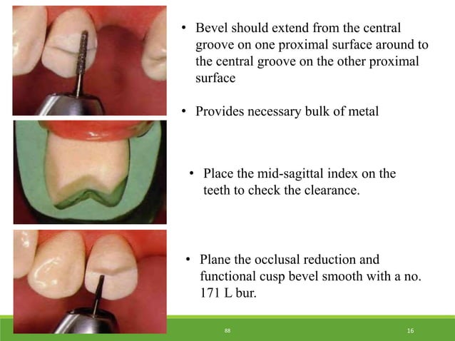 posterior partial veneer crowns - Kelly | PPTX | Dental Health ...