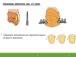 posterior partial veneer crowns - Kelly | PPTX