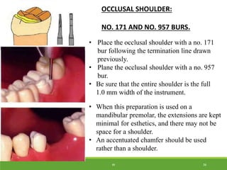 posterior partial veneer crowns - Kelly | PPTX