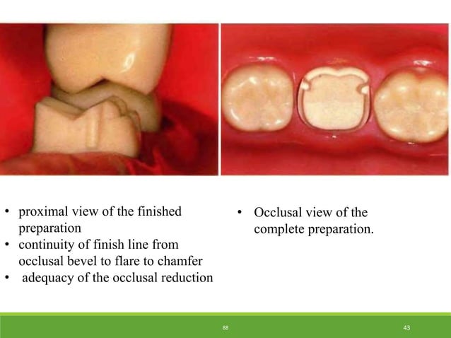 posterior partial veneer crowns - Kelly | PPTX | Dental Health ...