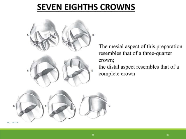 posterior partial veneer crowns - Kelly | PPTX | Dental Health ...