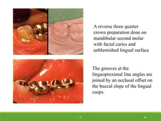 posterior partial veneer crowns - Kelly | PPT