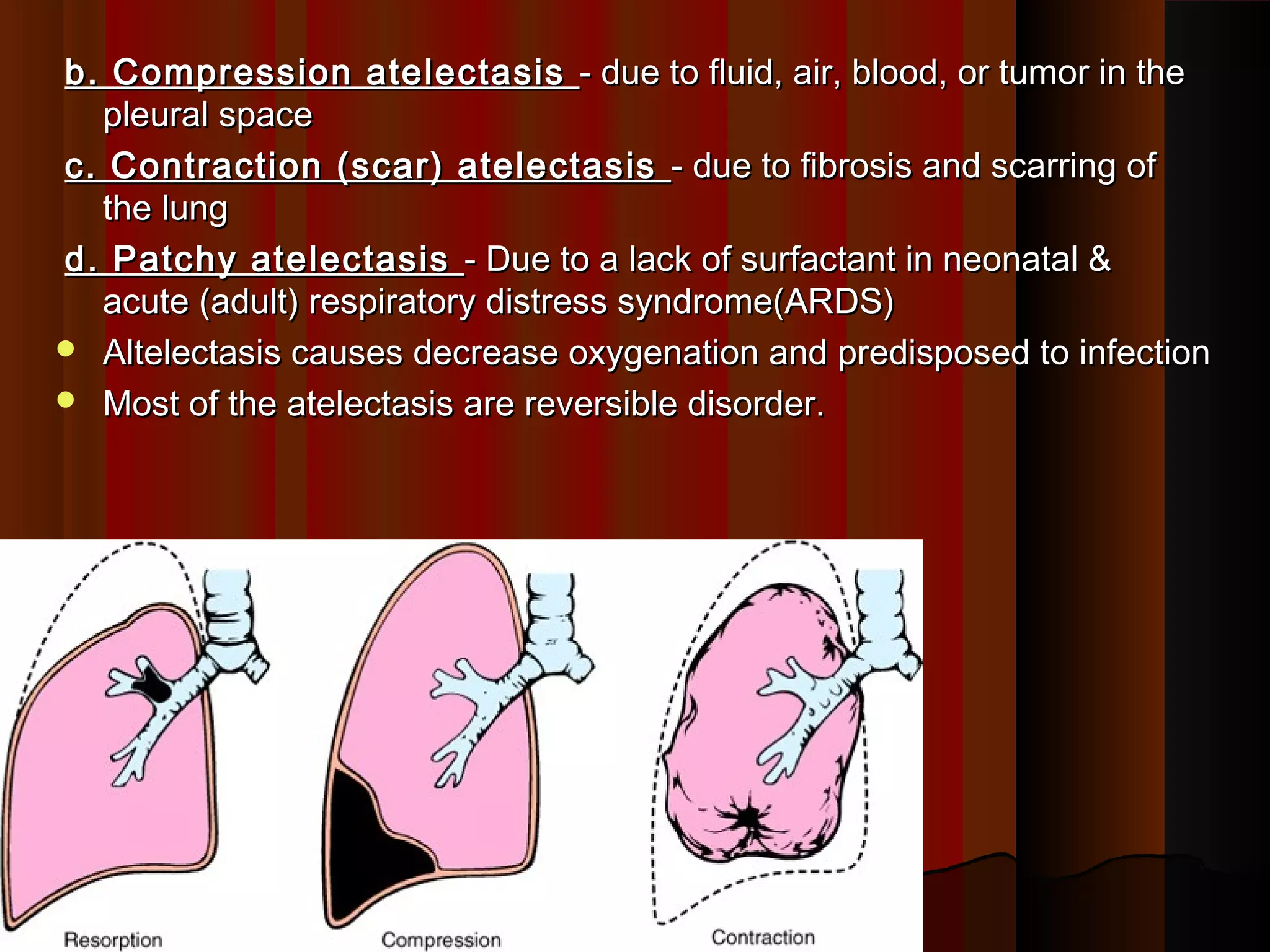 9.atelectasis | PPT