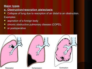 9.atelectasis | PPT