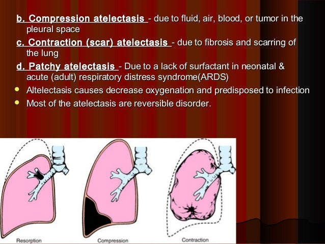 9.atelectasis