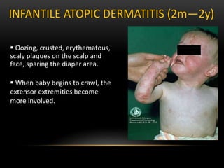 9. Eczema & dermatitis | PPTX