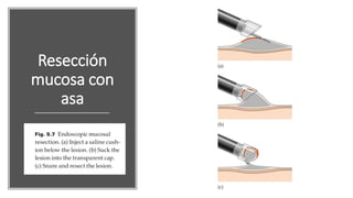Biopsia por endoscopia | PPTX