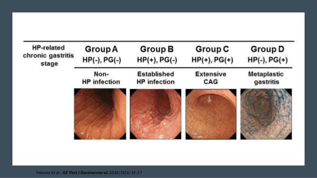 Biopsia por endoscopia