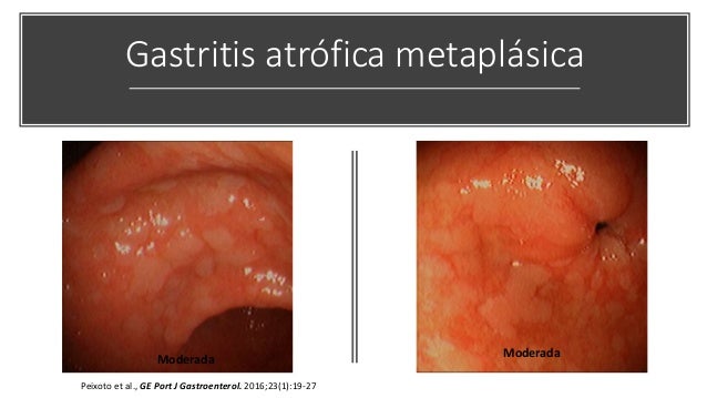 Biopsia por endoscopia