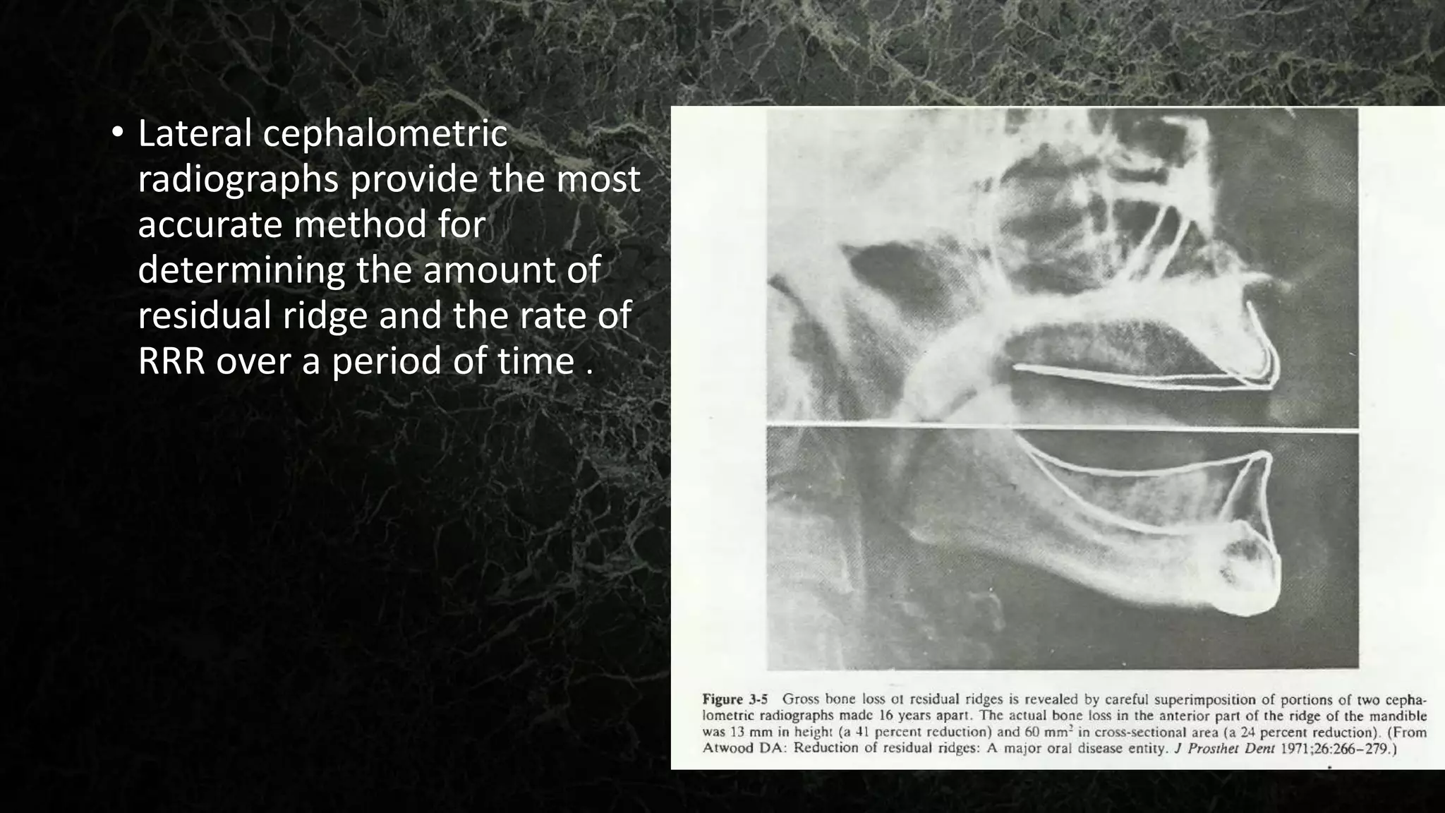 residual ridge resorption | PPTX | Bone and Joint Conditions | Diseases ...