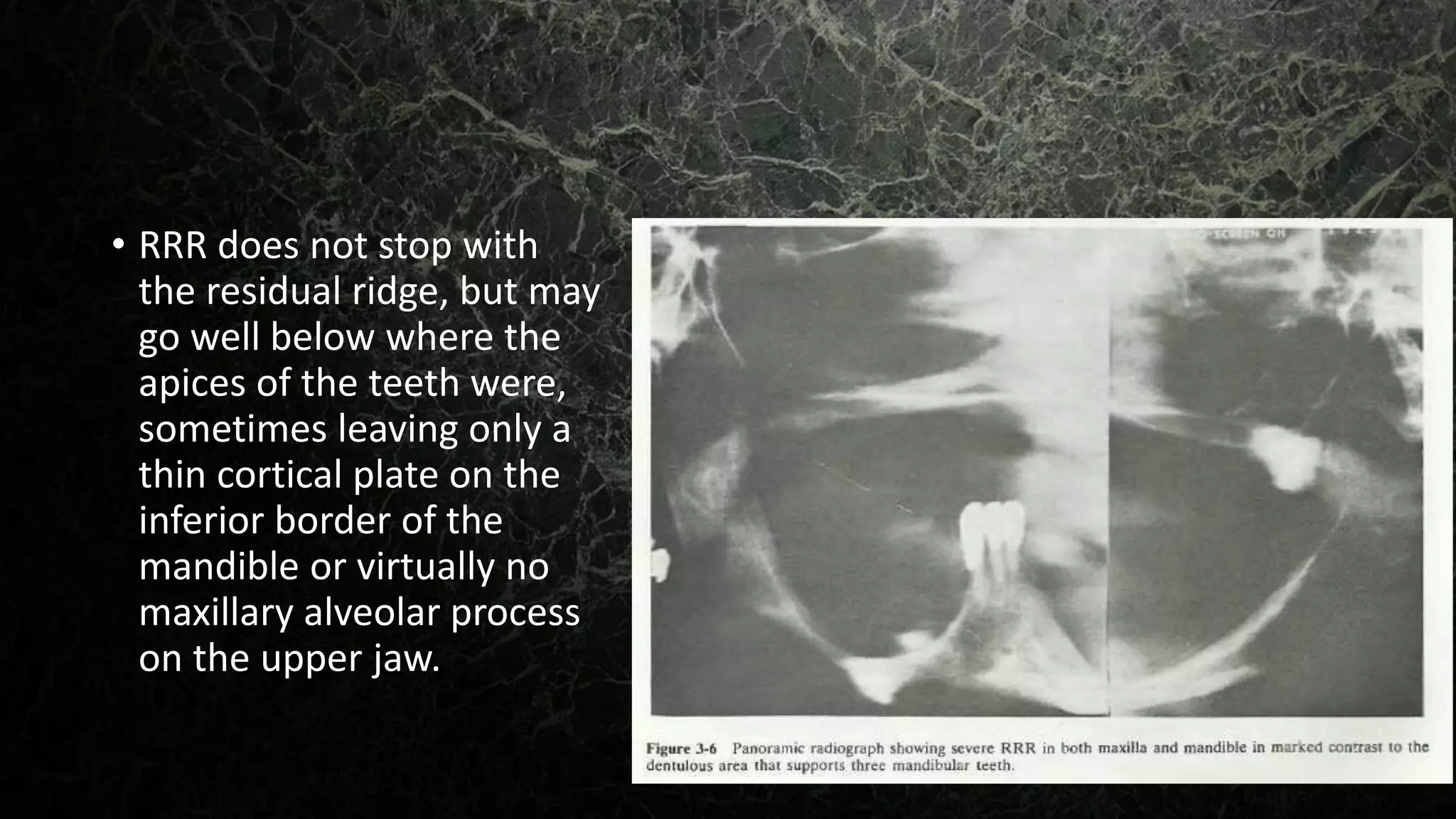 residual ridge resorption | PPTX | Bone and Joint Conditions | Diseases ...