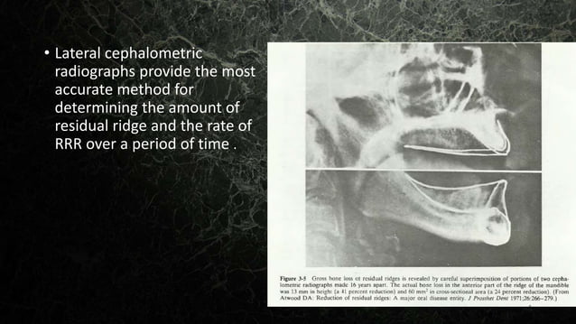 residual ridge resorption | PPTX | Bone and Joint Conditions | Diseases ...