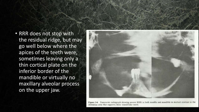 residual ridge resorption | PPTX | Bone and Joint Conditions | Diseases ...