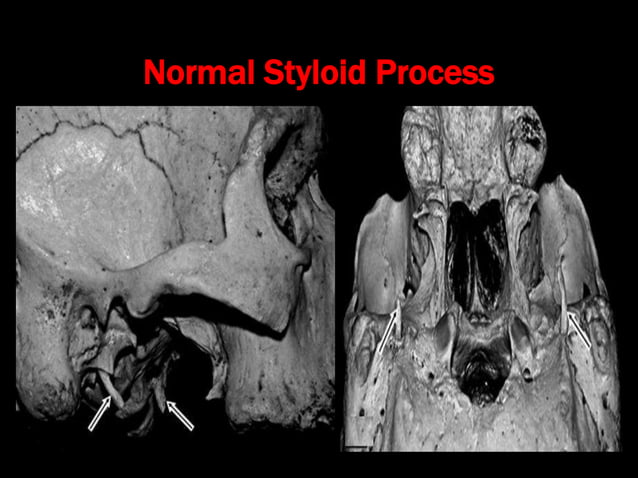 Hypopharyngeal pouch and stylalgia | PPT | Free Download