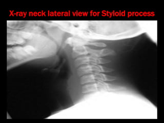 Styloid Process X Ray