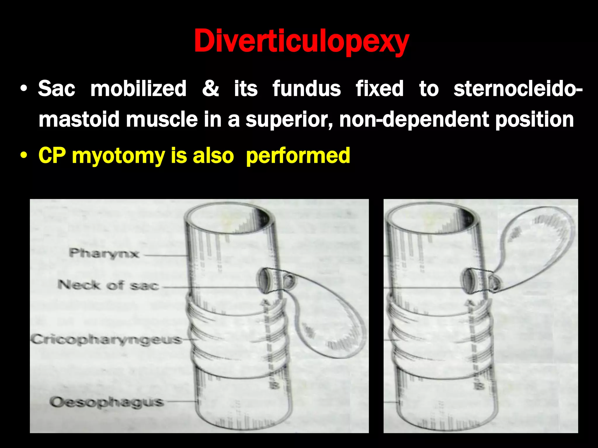 Hypopharyngeal pouch and stylalgia | PPT | Death, Injury, or Military ...