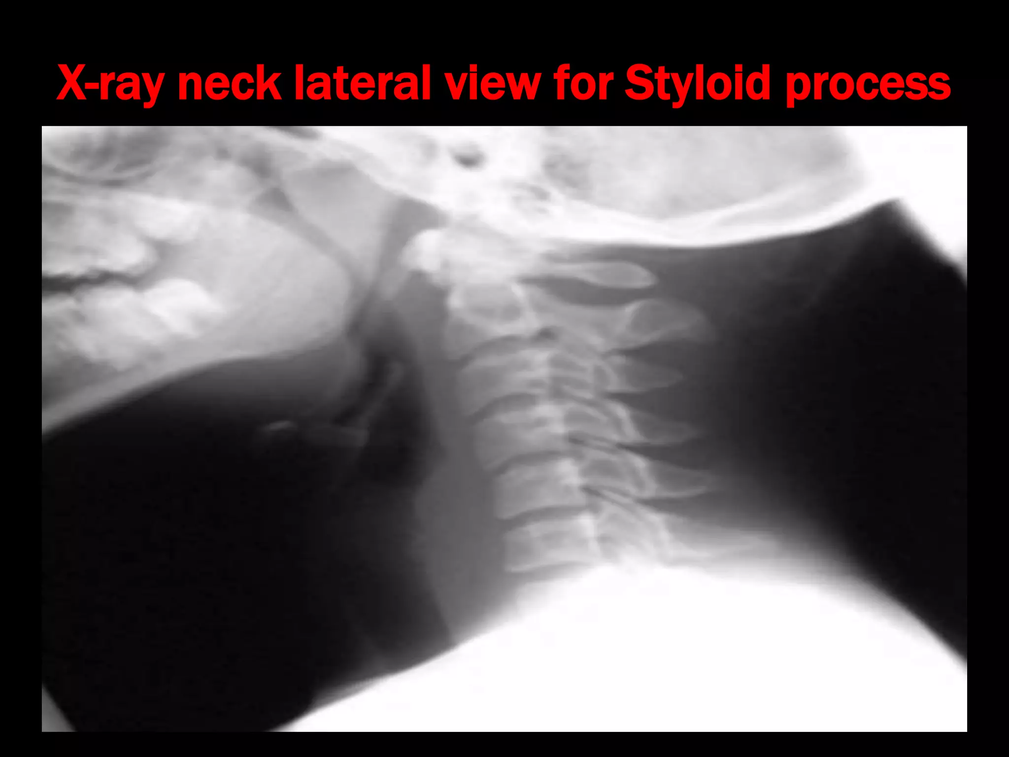 Hypopharyngeal pouch and stylalgia | PPT | Death, Injury, or Military ...