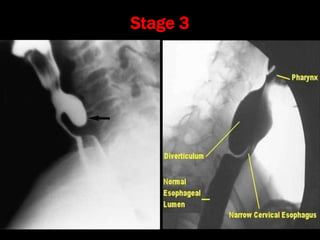 Hypopharyngeal pouch and stylalgia | PPT