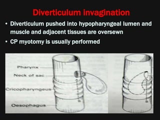 Hypopharyngeal pouch and stylalgia | PPT