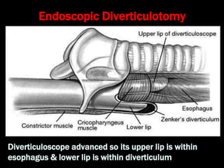 Hypopharyngeal pouch and stylalgia | PPT