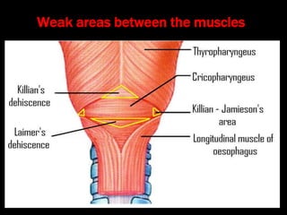 Hypopharyngeal pouch and stylalgia | PPT