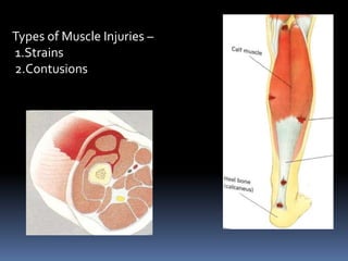 Physiotherapy Management in General Soft Tissue Injury | PPTX