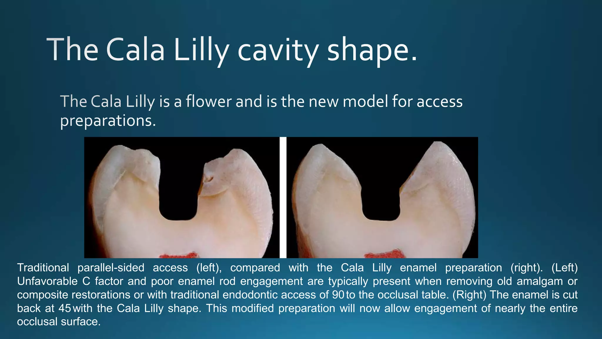 Modern Access Cavity Preparation | PPTX