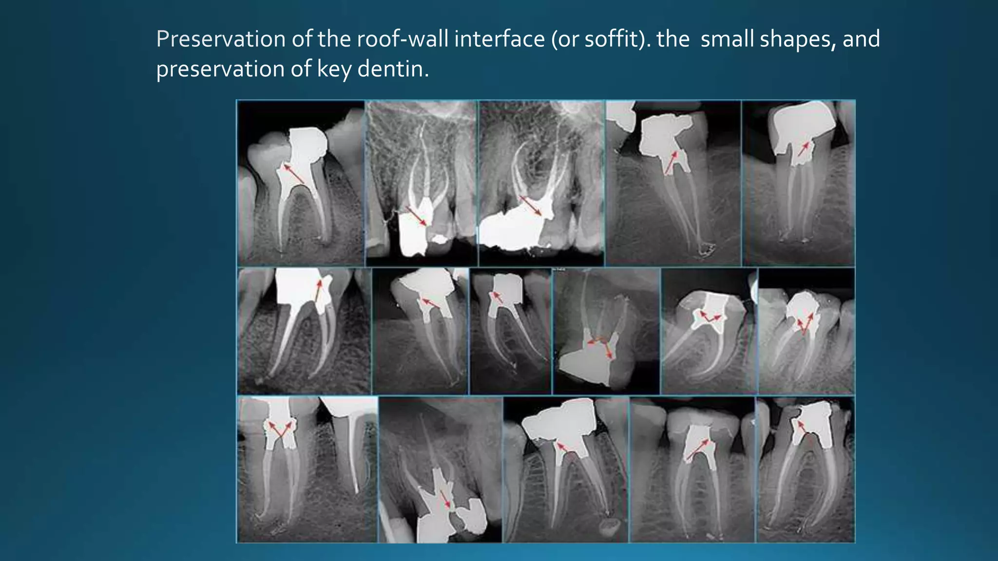 Modern Access Cavity Preparation | PPTX
