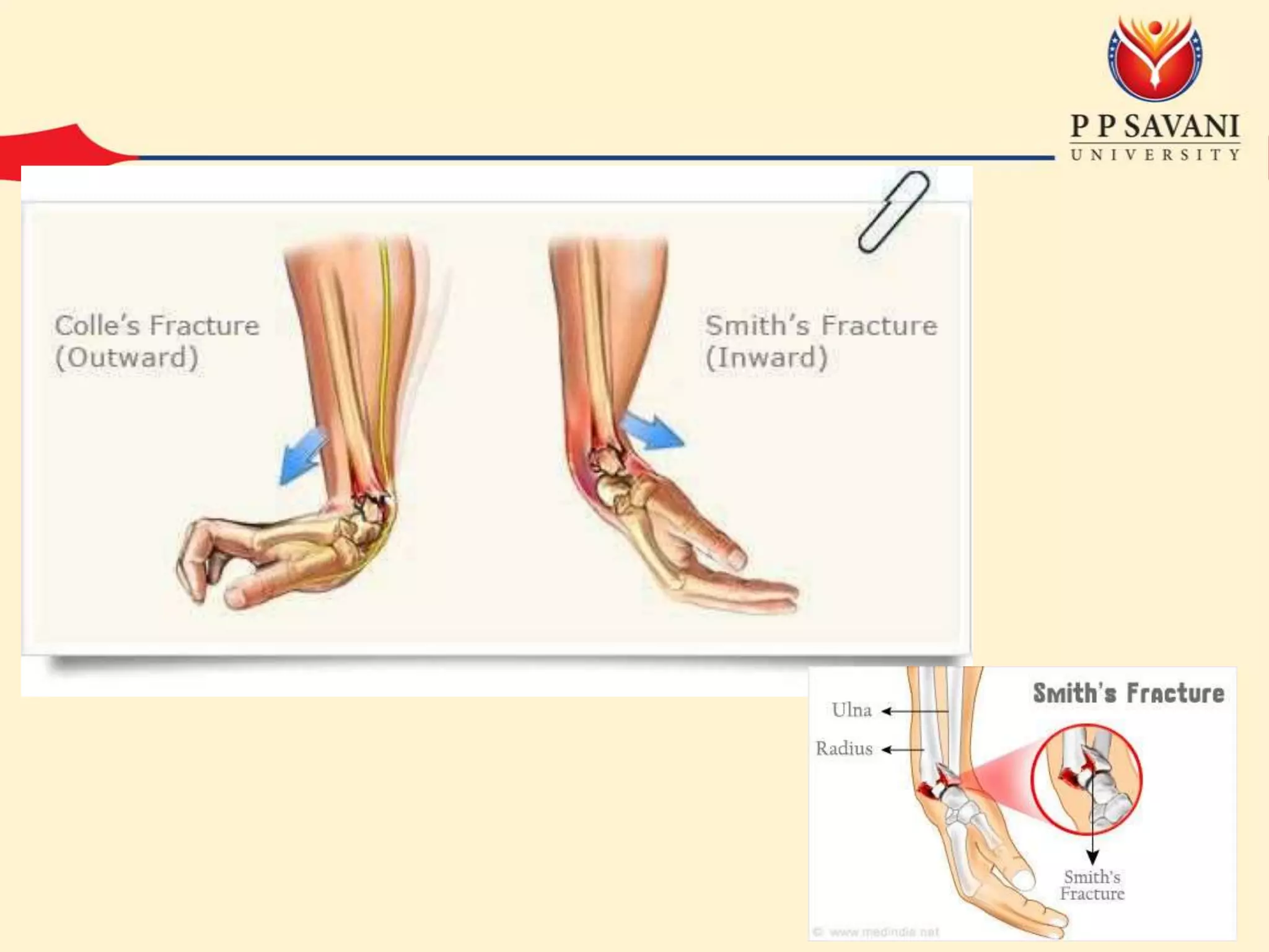 9. Forearm lower end fractures | PPT