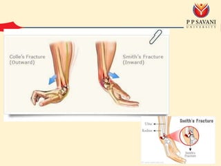 9. Forearm lower end fractures | PPT